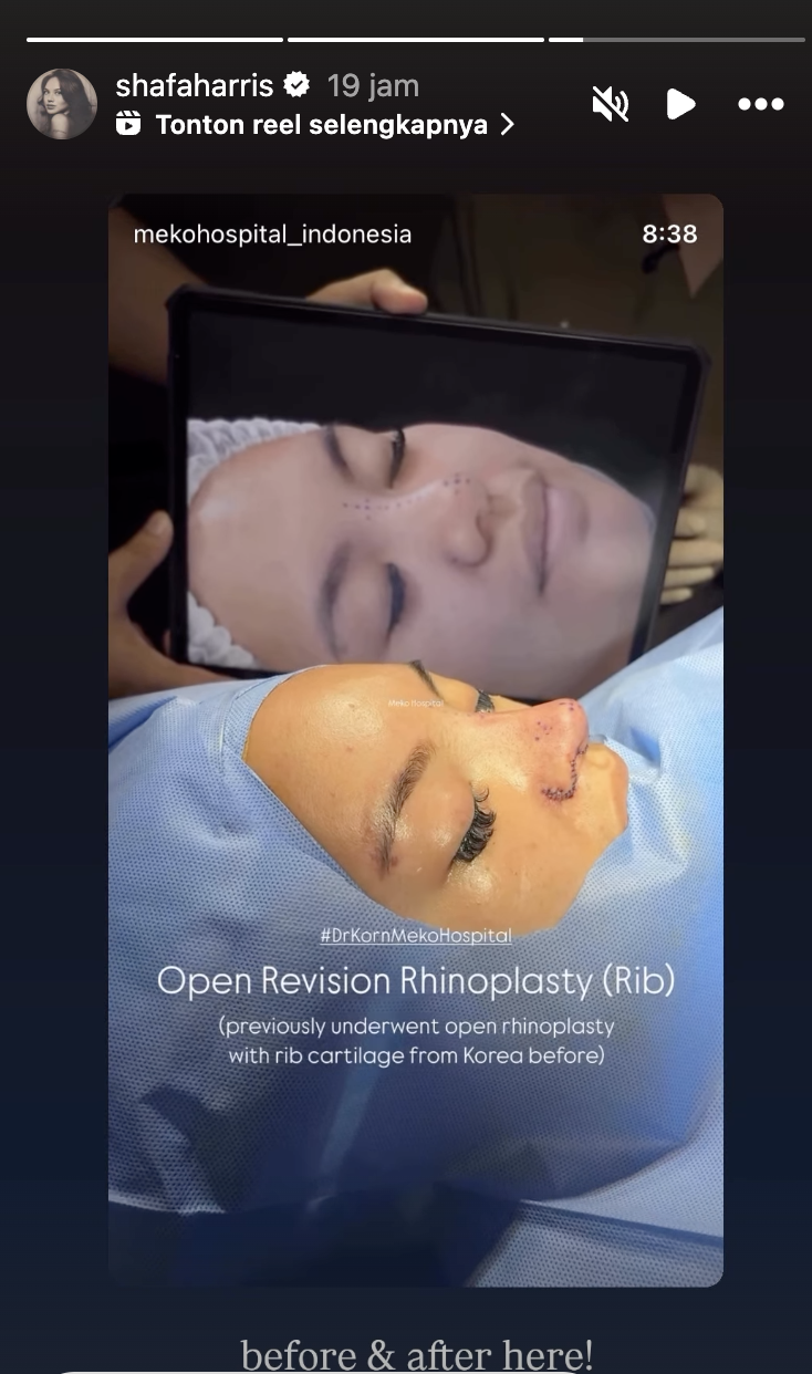 Perbaiki Oplas yang Gagal, Shafa Harris Pamer Kondisi Wajah usai ...
